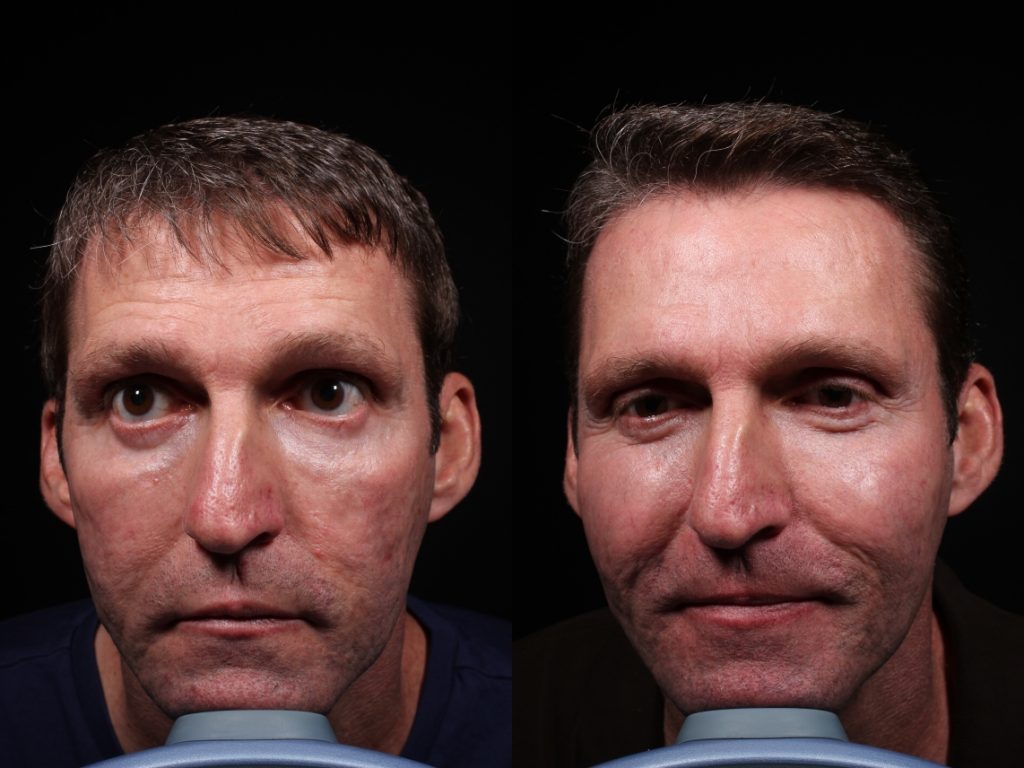 Facial Rejuvenation for Men in Vero Beach