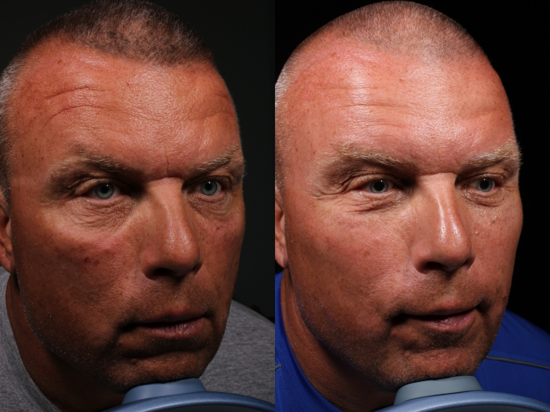 Facial Rejuvenation for Men in Vero Beach